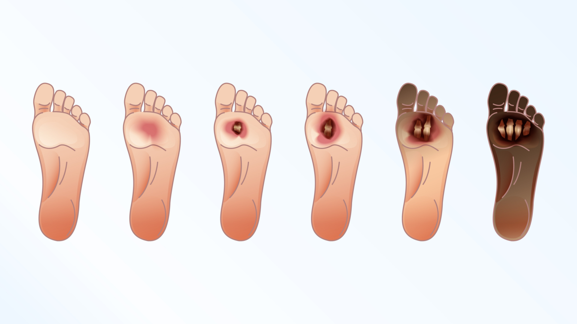 Ulcere venose - descrizione, trattamento e consigli dei medici